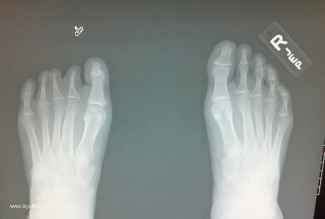 Blister GIF - CuteCrab Official Profile | www.Loyalfans.com